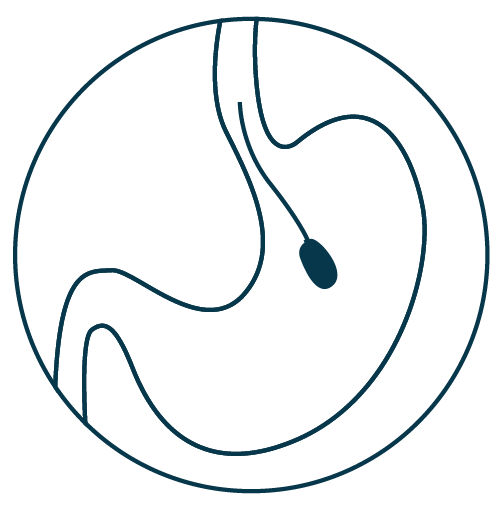 Allurion Intragastric Balloon in Bangalore – Dr Manish Joshi